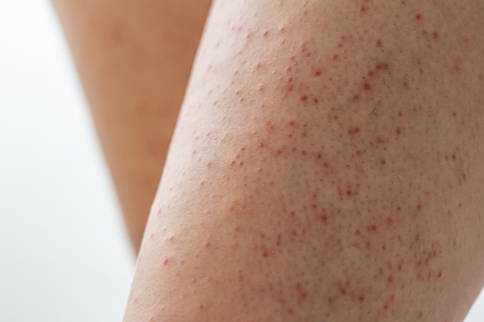 Bumpy Rash On Forearms Bumpy Rash On Forearms
